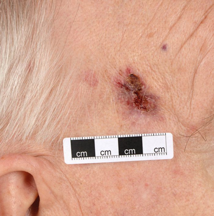 Recognition of head and neck skin cancer: A guide for GDPs : Ireland's ...