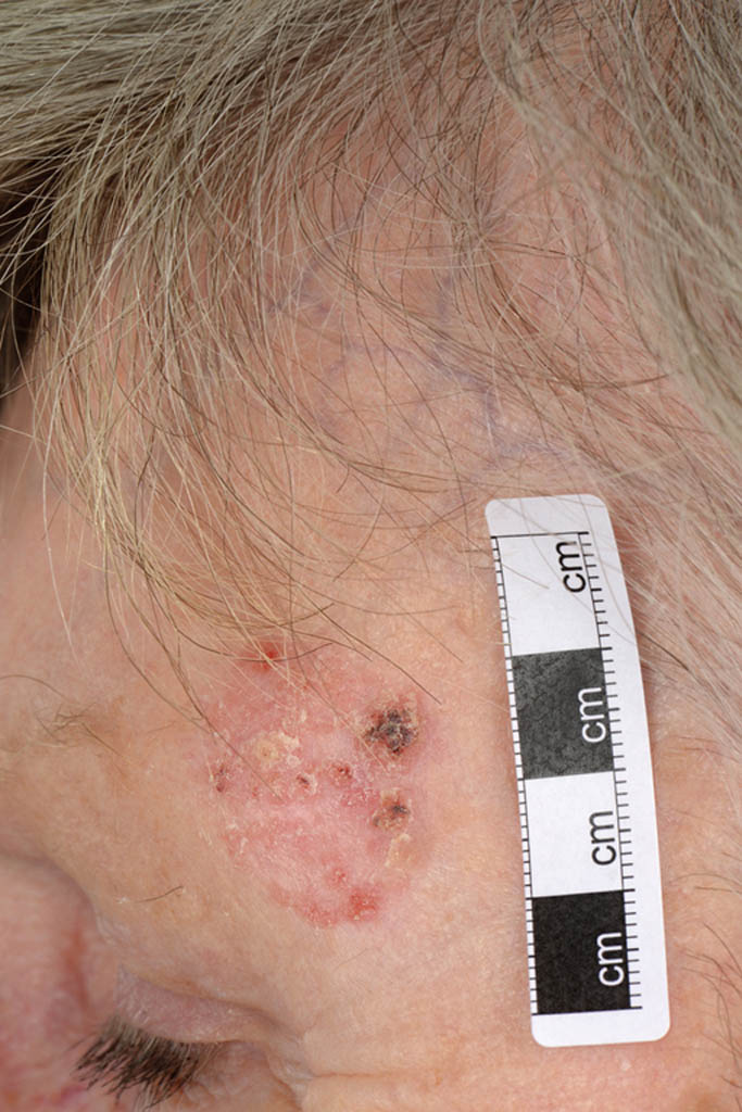 Recognition of head and neck skin cancer: A guide for GDPs : Ireland's ...