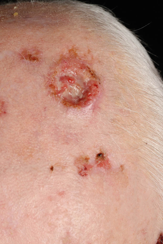 Recognition of head and neck skin cancer: A guide for GDPs : Ireland's ...